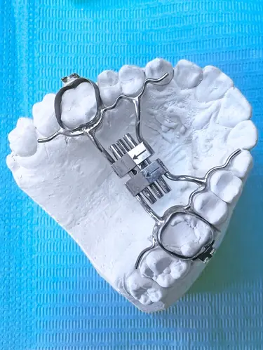 Exploring Maxillary Expansion: A Critical Look at MARPE and RPE Outcomes