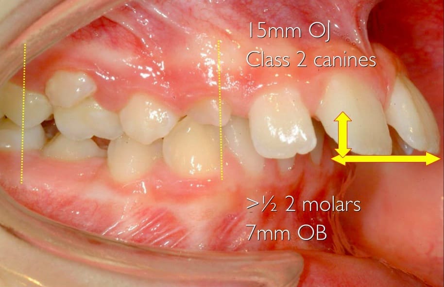 Summary Of Functional Appliance Treatment For Class II Malocclusion Summary Of Functional Appliance Treatment For Class II Malocclusion