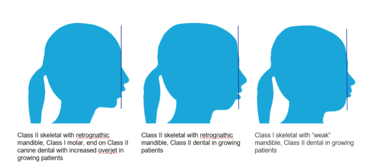 Align Technology Responde Ao Meu Post Sobre O Avan o Mandibular Com O align-technology-responde-ao-meu-post-sobre-o-avan-o-mandibular-com-o