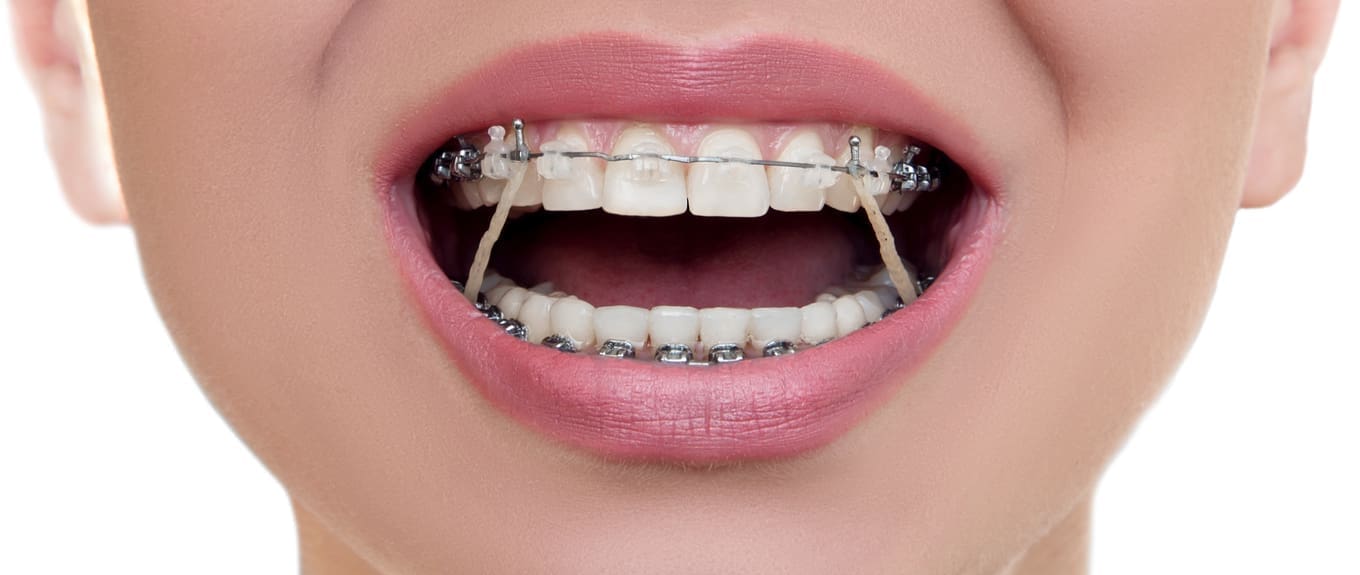 Are Class II Elastics As Effective As A Functional Appliance A Trial Are Class II Elastics As Effective As A Functional Appliance A Trial