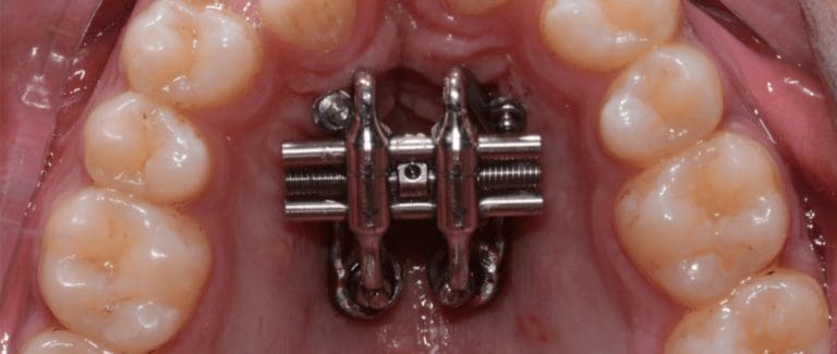 Maxillary Expansion with skeletal anchorage explained: MSE vs Hybrid ...