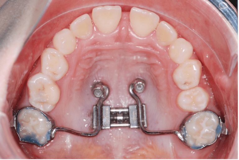 Maxillary Expansion with skeletal anchorage explained: MSE vs Hybrid Hyrax - Kevin O'Brien's ...