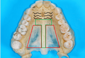 Maxillary Expansion with skeletal anchorage explained: MSE vs Hybrid ...
