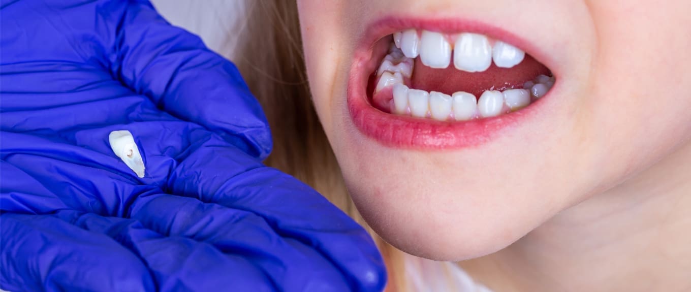 Extraction of primary canines: Authors response. - Kevin O'Brien's ...