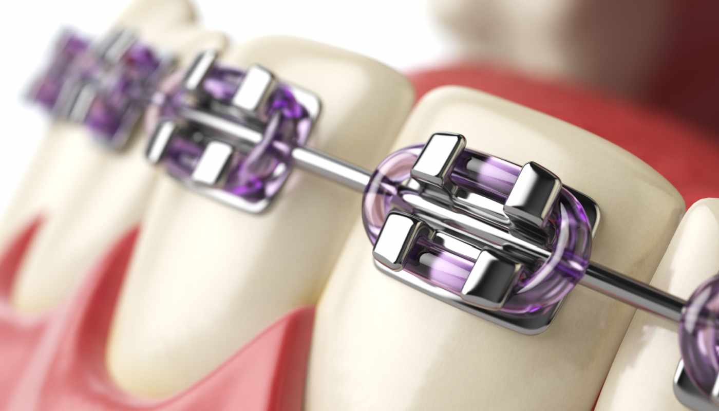 Let’s have a look at the evidence on pre-adjusted edgewise fixed ...