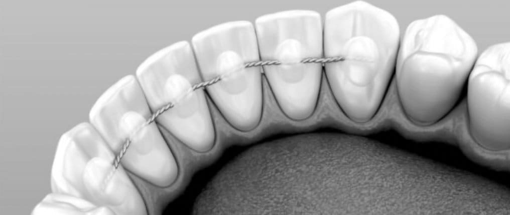 Are Bonded retainers better than vacuum-formed retainers, a new RCT?