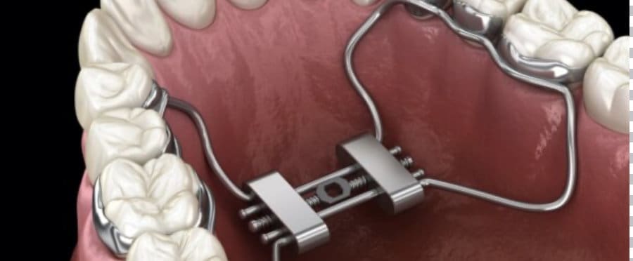 What is better? Quad helix or RME for maxillary expansion.