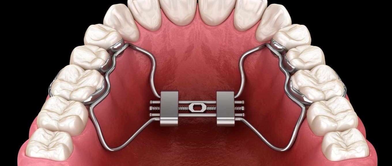 Expansion with Aligners or RME. What is better?