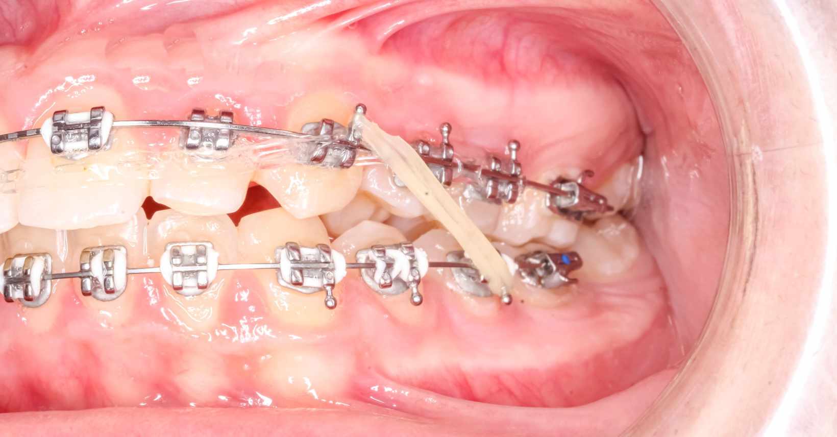 Early vs. Late Class II Elastics: Impact on Treatment Duration and Outcomes